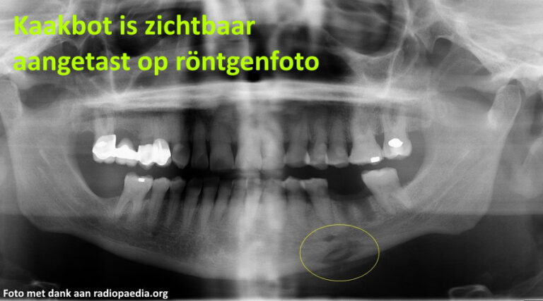 Wat is een kaakonsteking (Osteomyelitis)? | Nederlands Tandarts Instituut